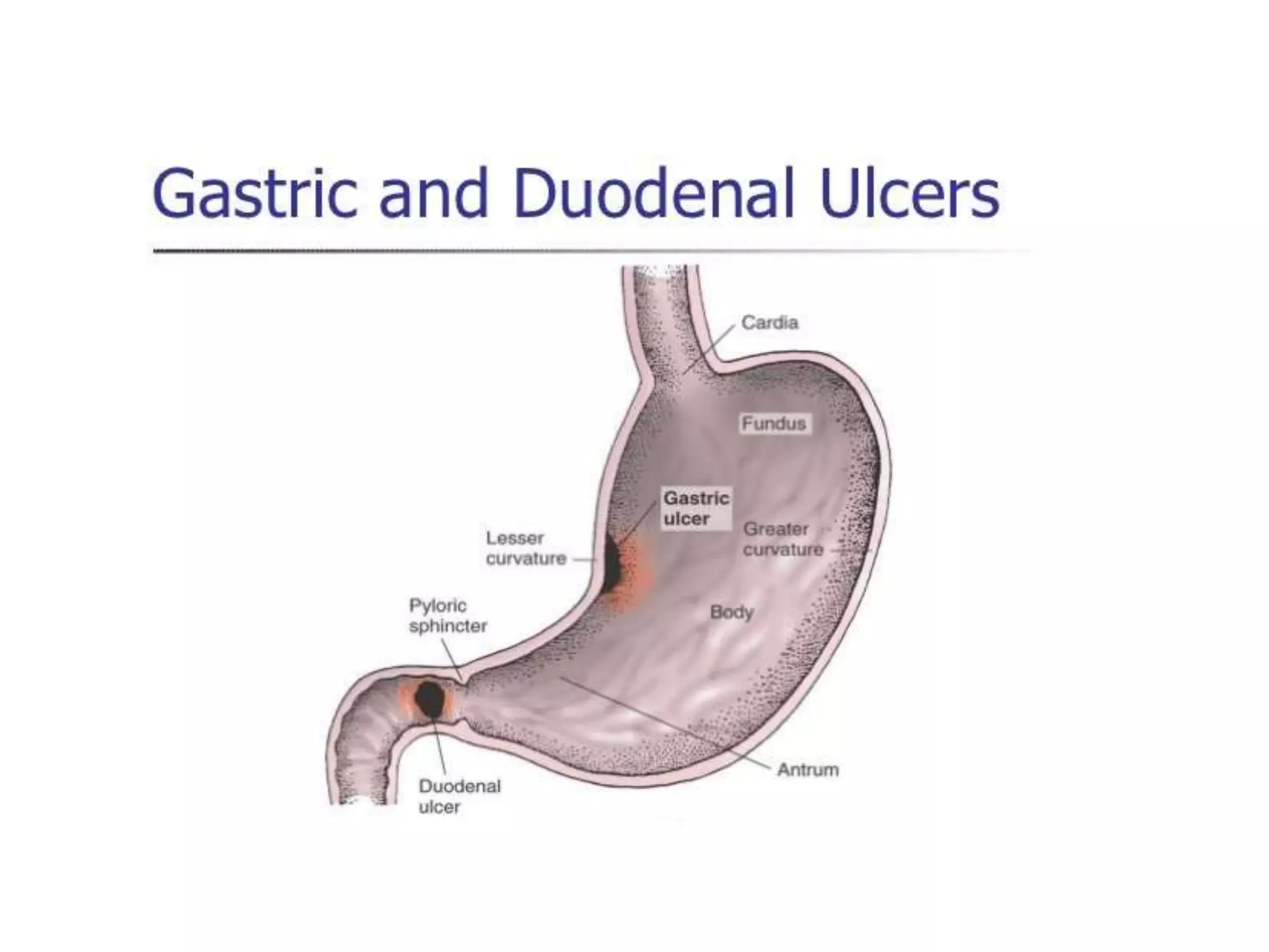 Peptic Ulcer | PPT
