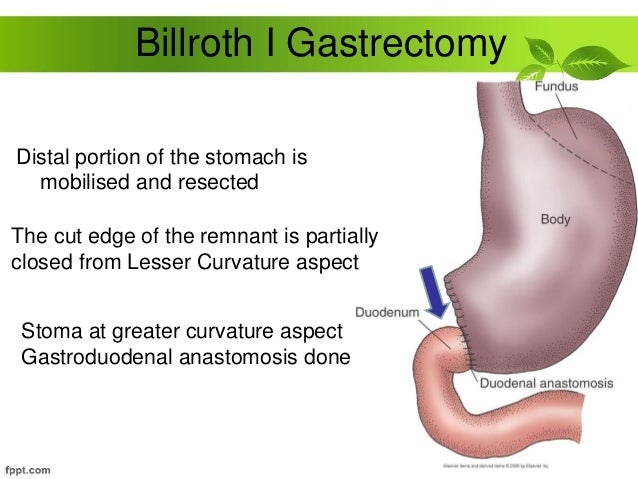 Billroth 1 Versus 2 Procedure