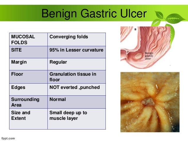 Peptic ulcer
