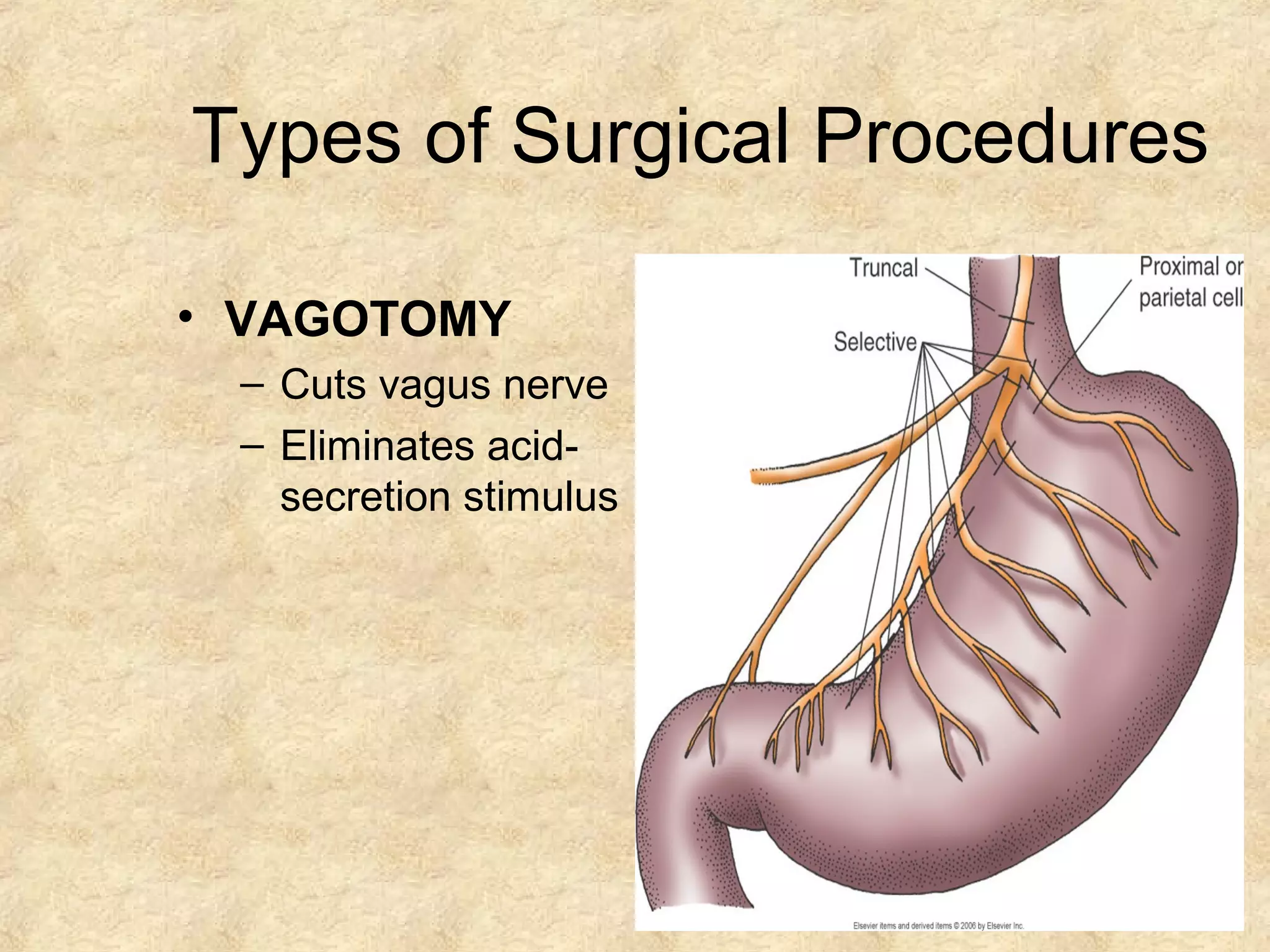Peptic ulcer | PPT