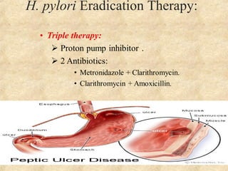 Peptic ulcer | PPT