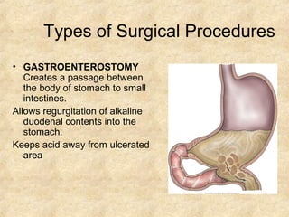 Peptic ulcer | PPT