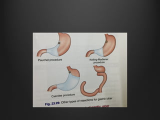 Teapot Stomach