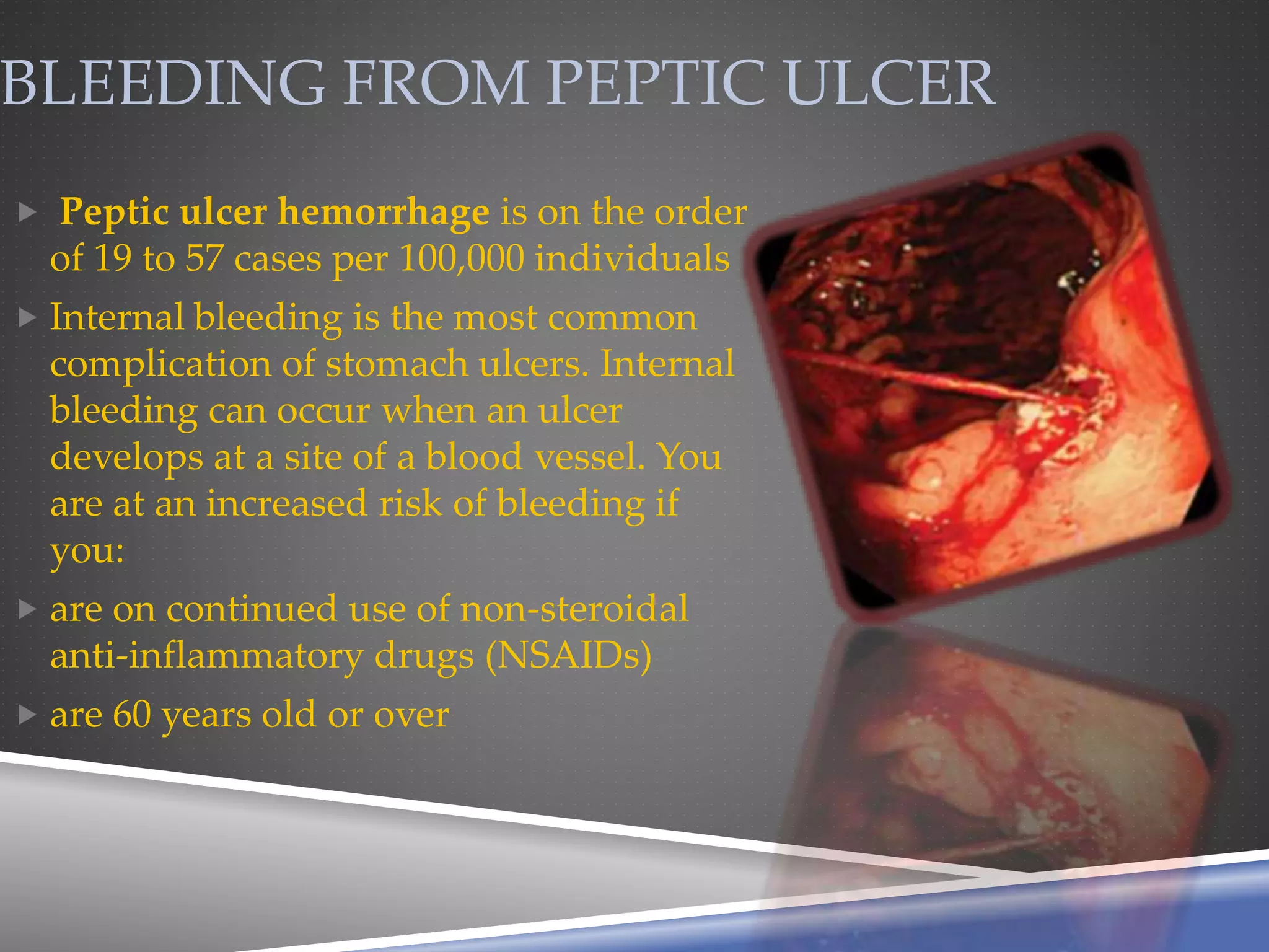 Peptic Ulcer Complications | PPTX