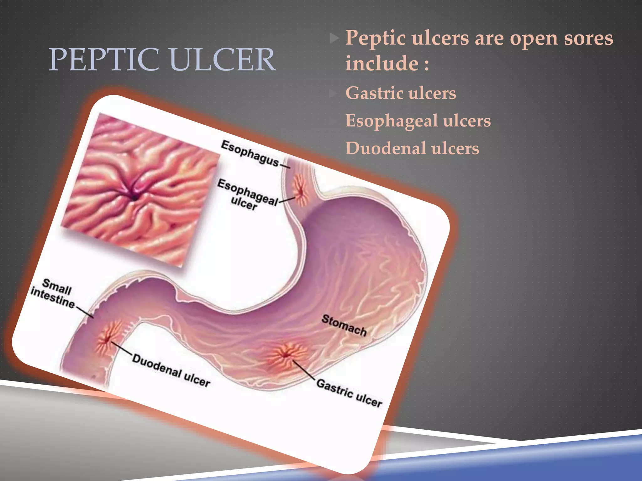 Peptic Ulcer Complications | PPTX