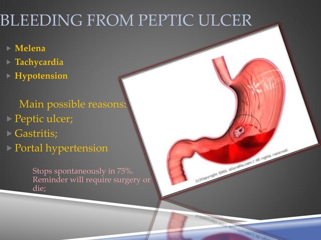 Peptic Ulcer Complications | PPTX | Digestive Disorders | Diseases and ...