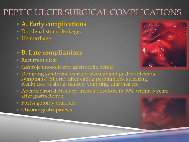 Peptic Ulcer Complications | PPTX | Digestive Disorders | Diseases and ...