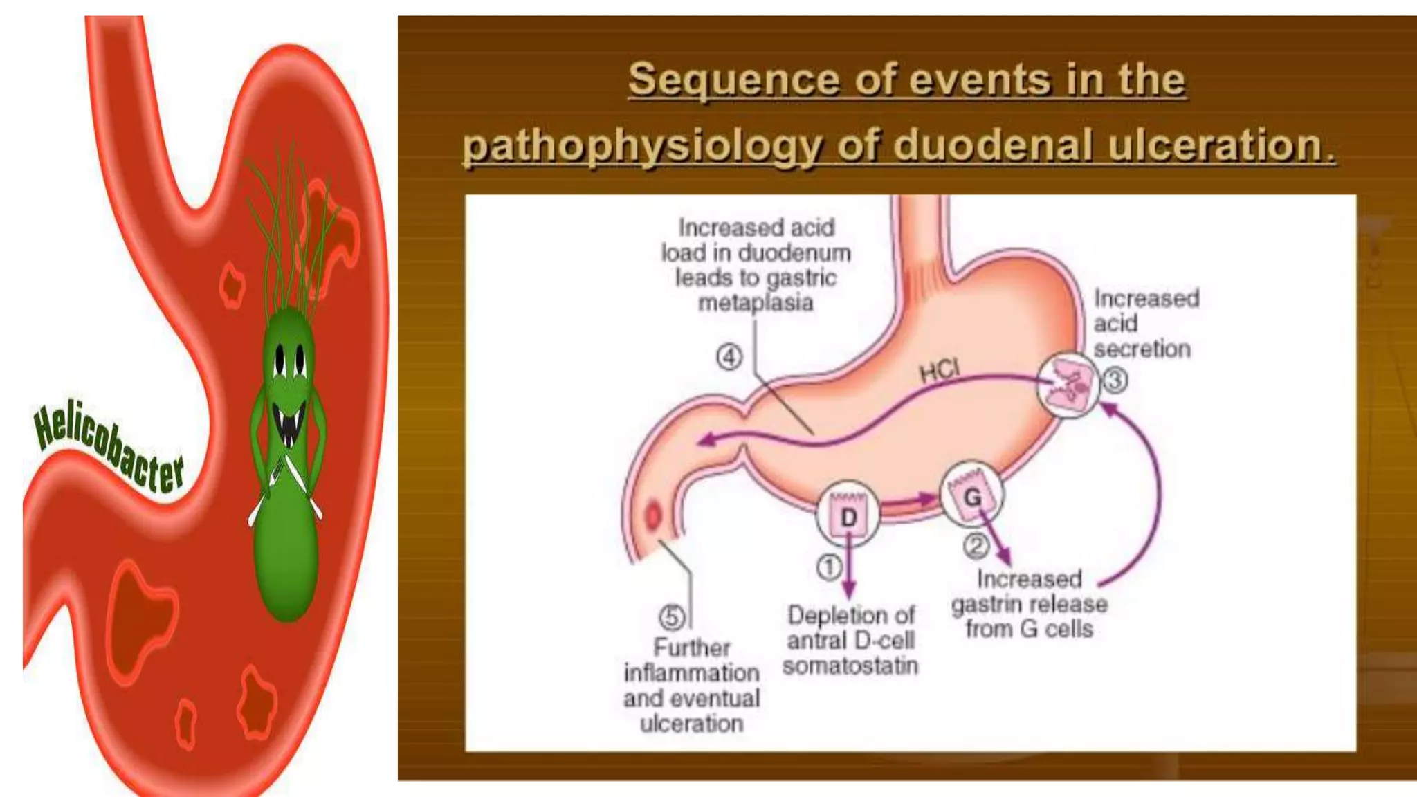 Peptic ulcer | PPTX