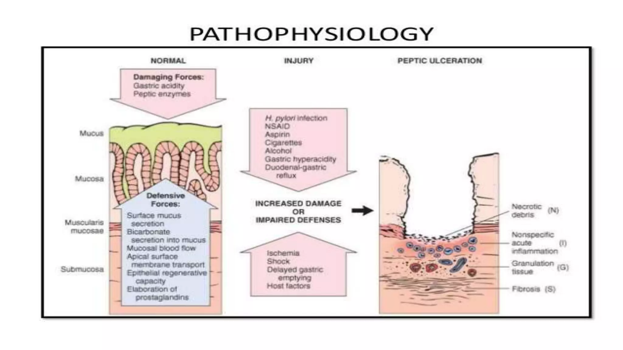 Peptic ulcer | PPTX