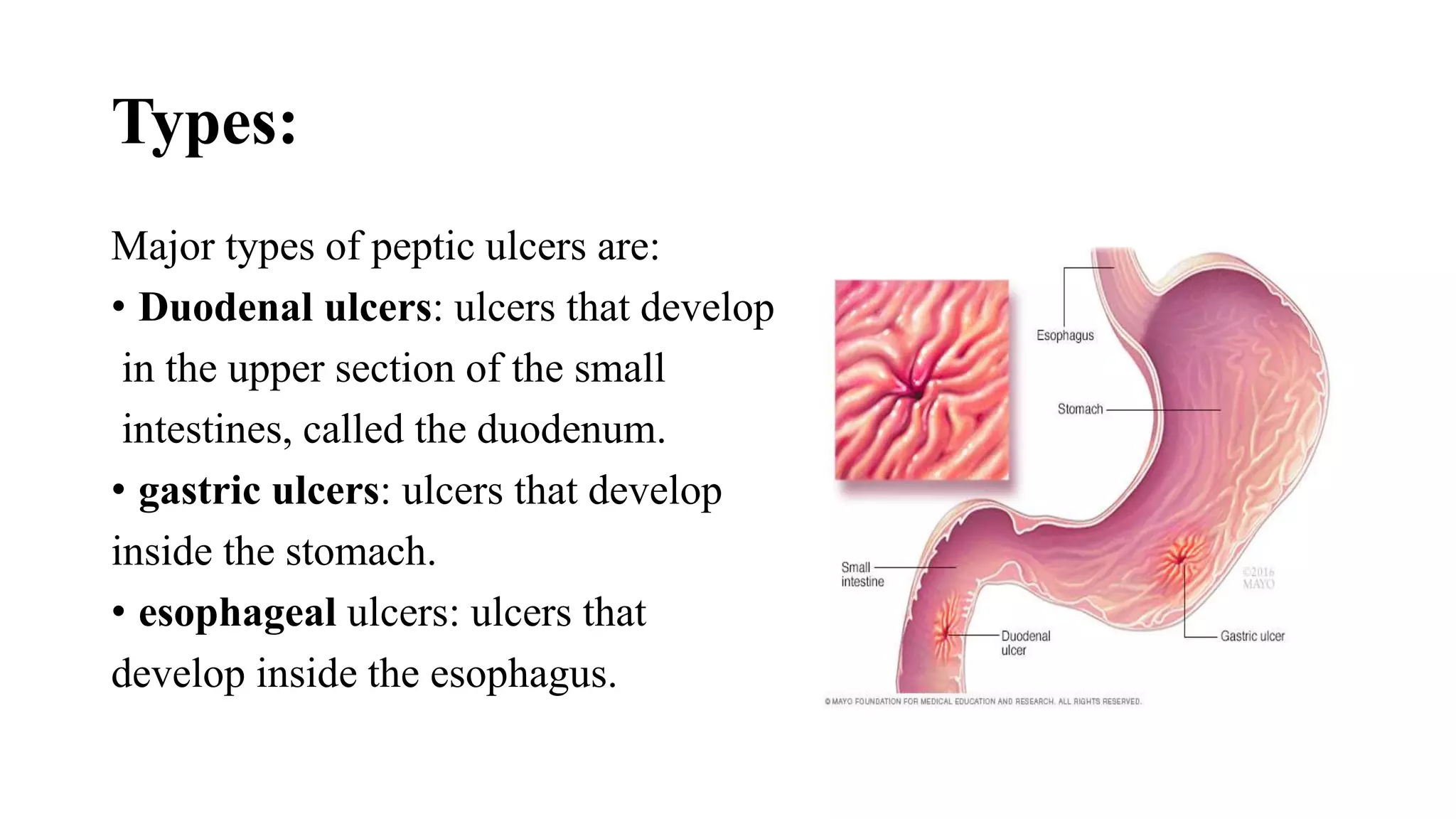 Peptic ulcer | PPTX