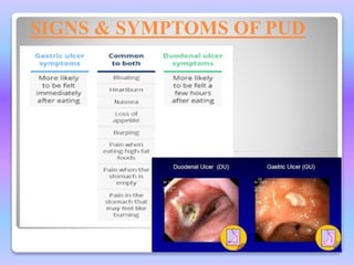 Peptic ulcer | PPT
