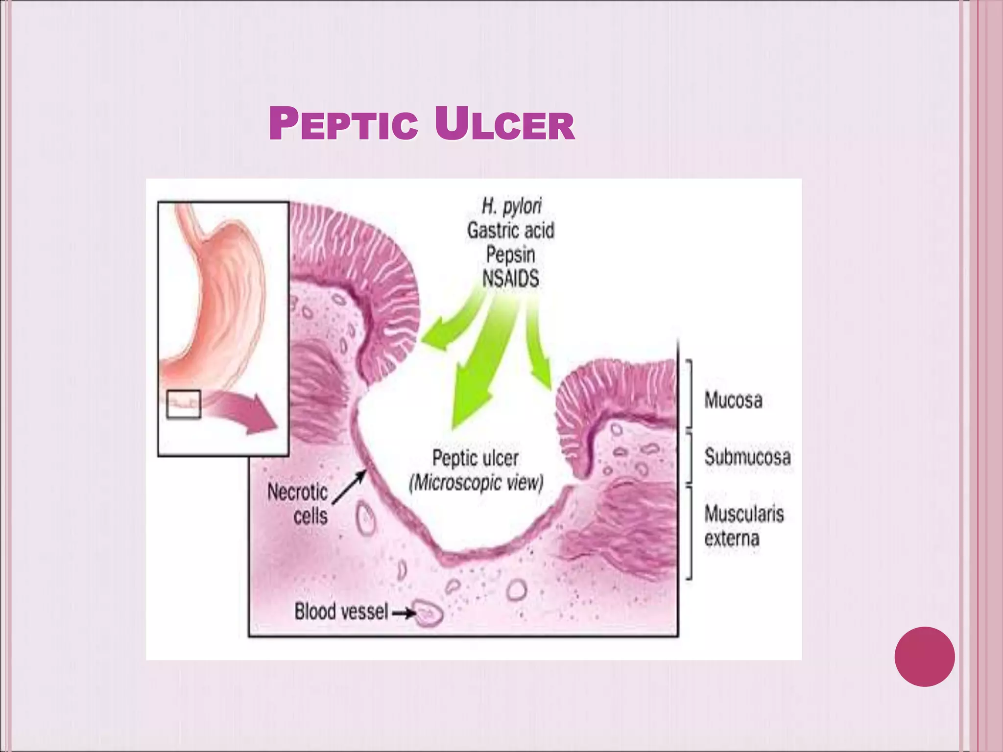 pathophysiology of peptic ulcers | PPT