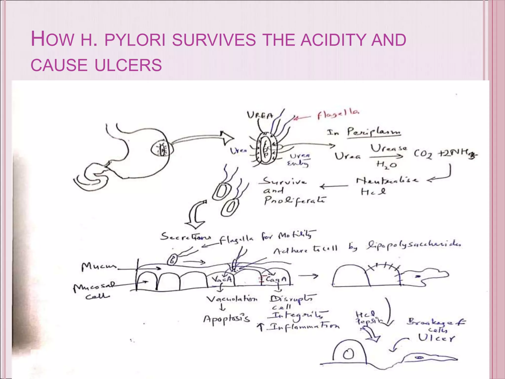 pathophysiology of peptic ulcers | PPT