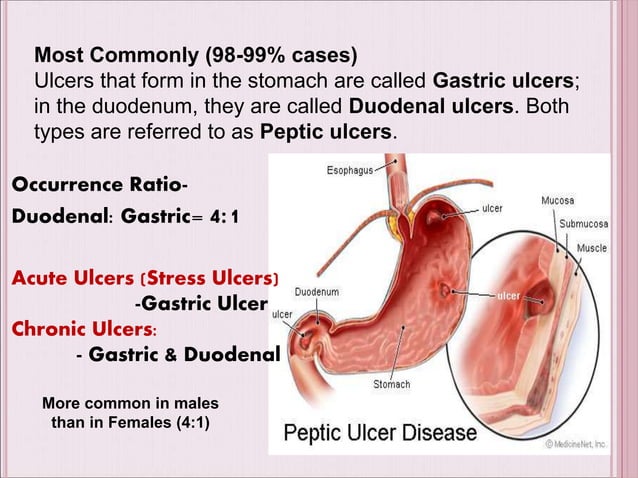 pathophysiology of peptic ulcers | PPT