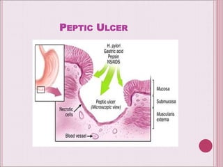 pathophysiology of peptic ulcers | PPT