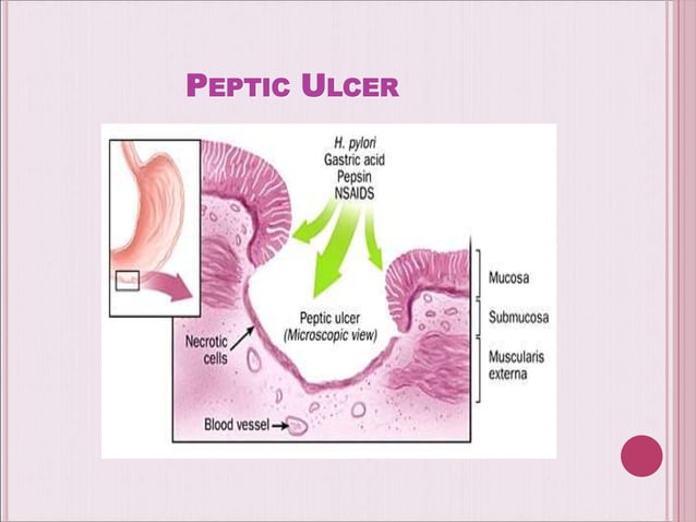 pathophysiology of peptic ulcers