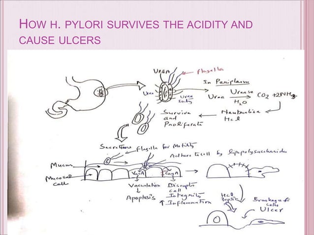 pathophysiology of peptic ulcers | PPT
