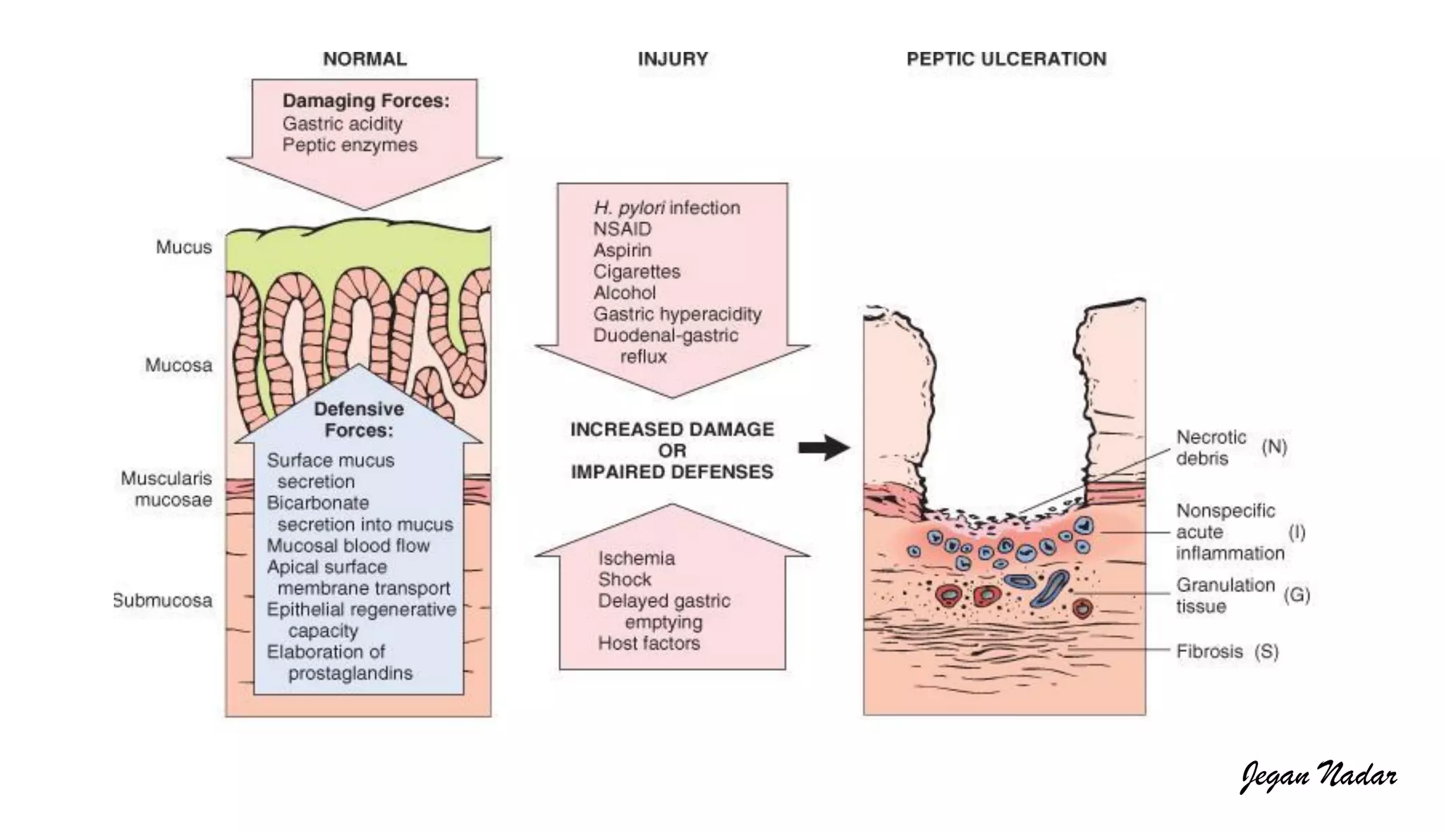 Pathophysiology of Peptic ulcer | PDF
