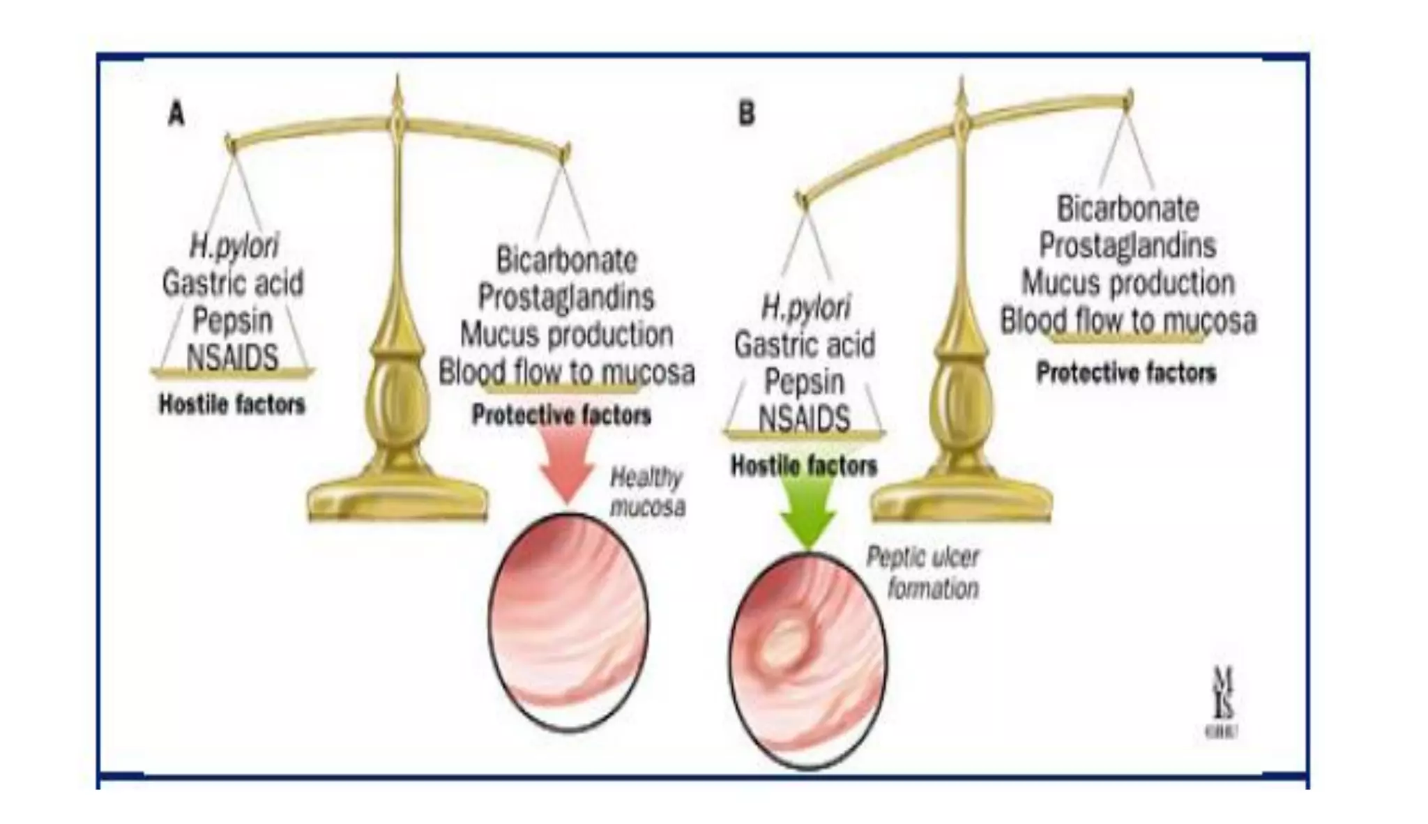 Pathophysiology of Peptic ulcer | PDF
