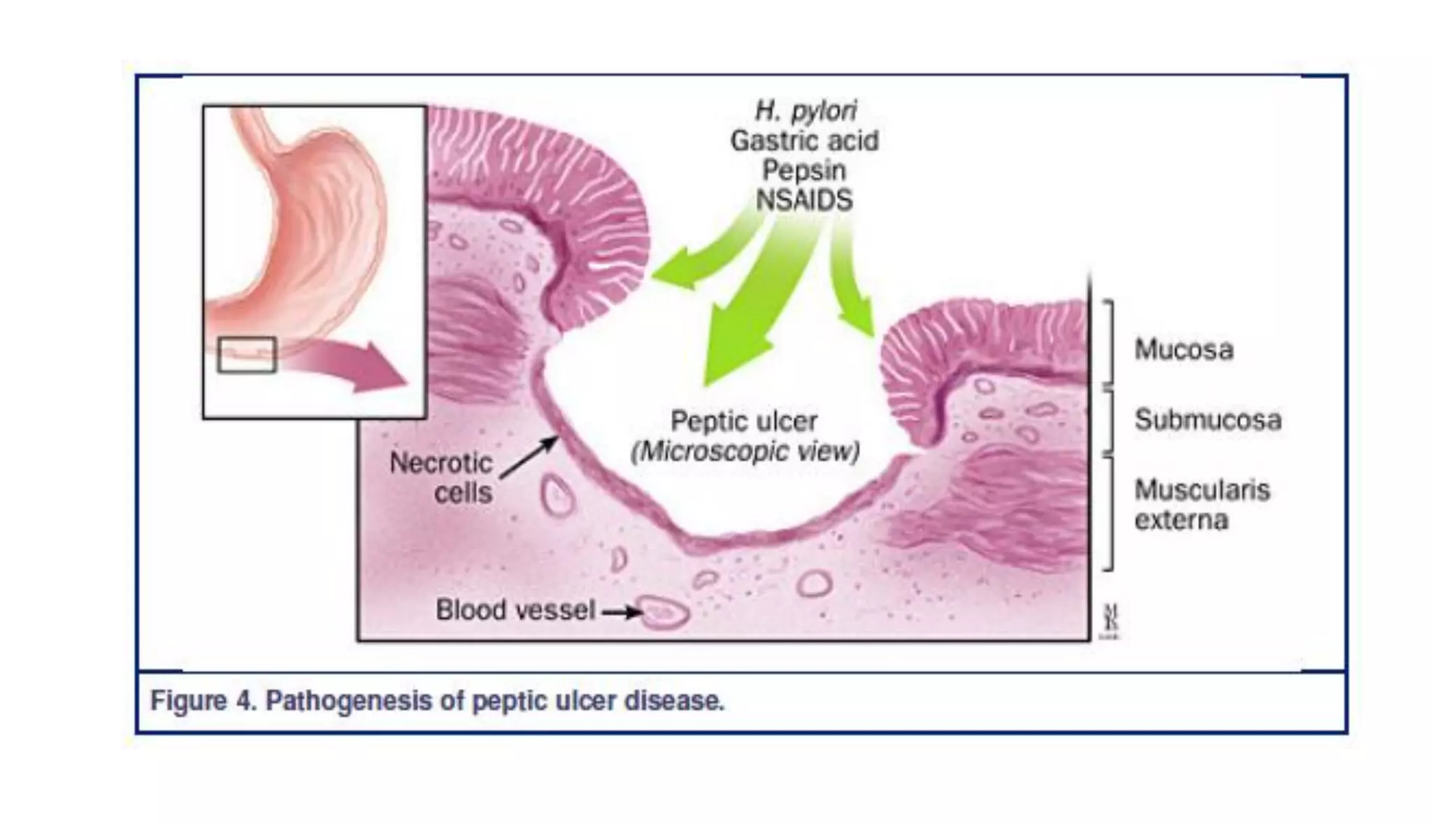 Pathophysiology of Peptic ulcer | PDF