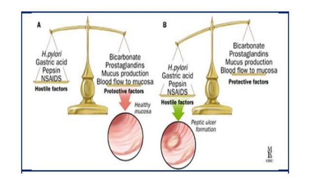 Pathophysiology of Peptic ulcer | PDF