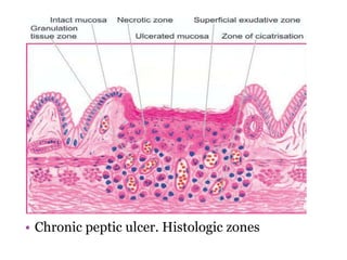 Peptic ulcer | PPT