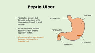 Peptic ulcer | PPTX