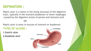 Peptic ulcer | PPT