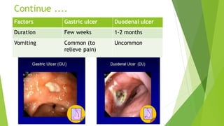 Peptic ulcer | PPT