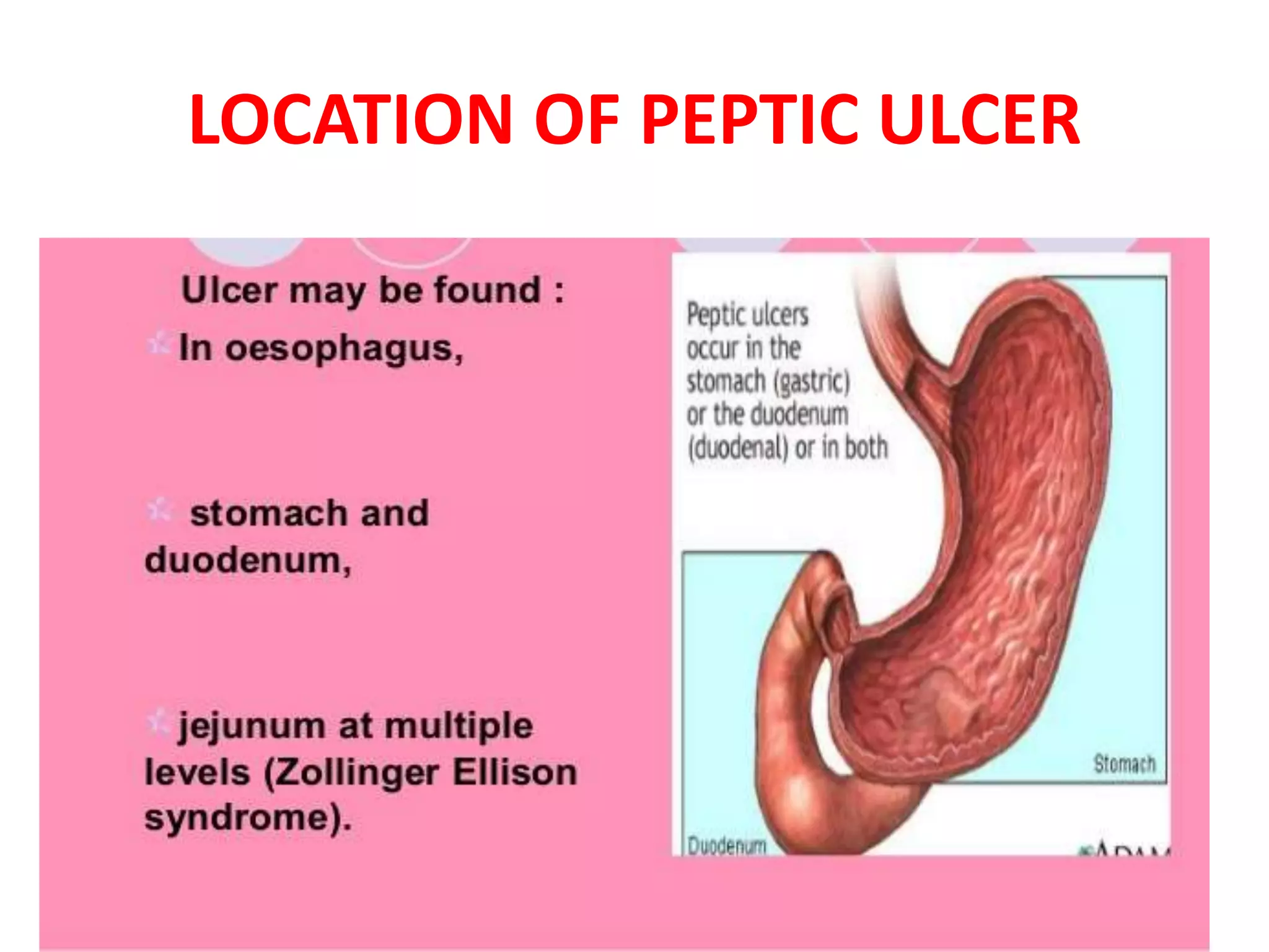 Peptic ulcer | PPTX