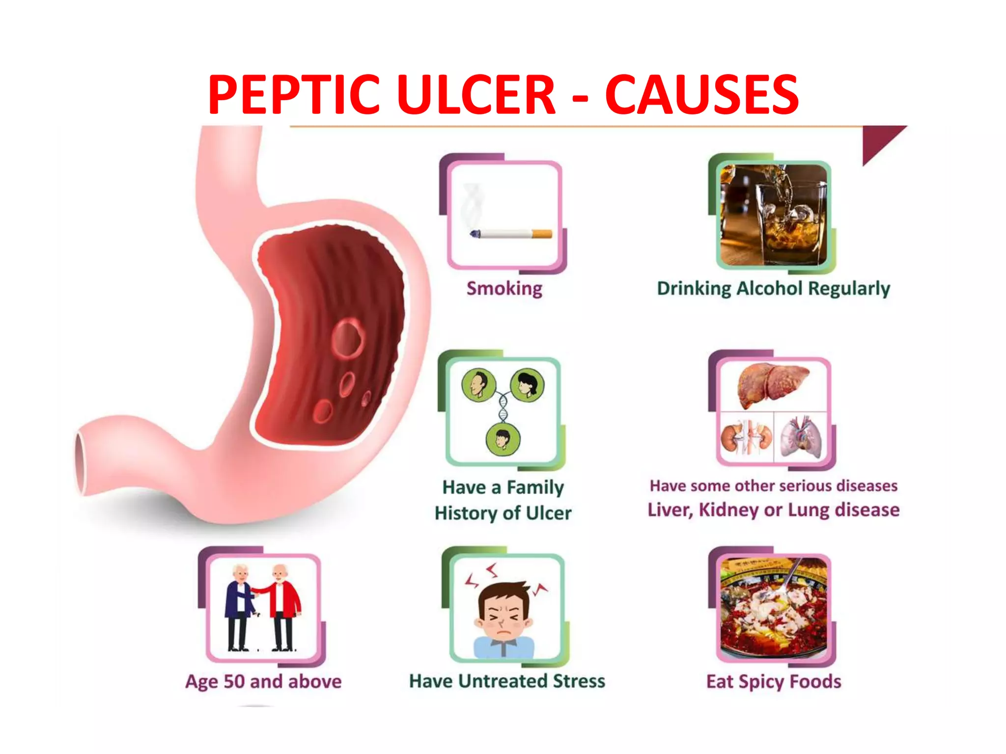 Peptic ulcer | PPTX