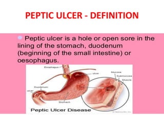 Peptic ulcer | PPTX