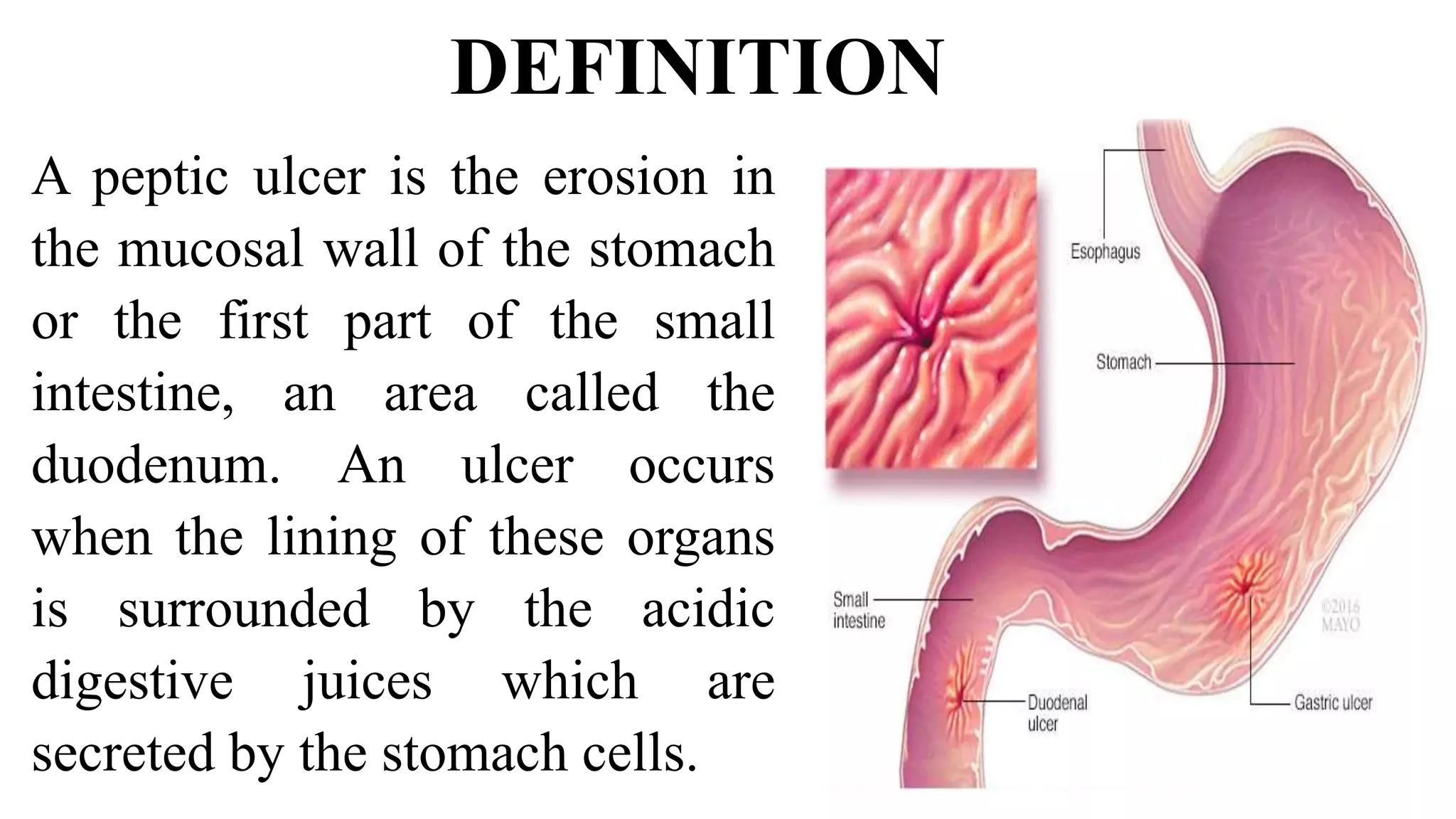 Peptic ulcer.pptx