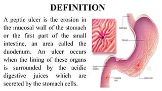 Peptic ulcer.pptx