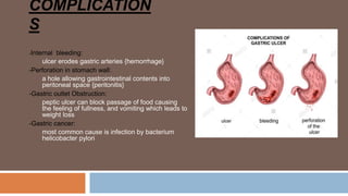 Peptic ulcer.pptx