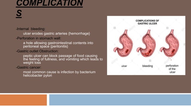 Peptic ulcer.pptx | Digestive Disorders | Diseases and Conditions