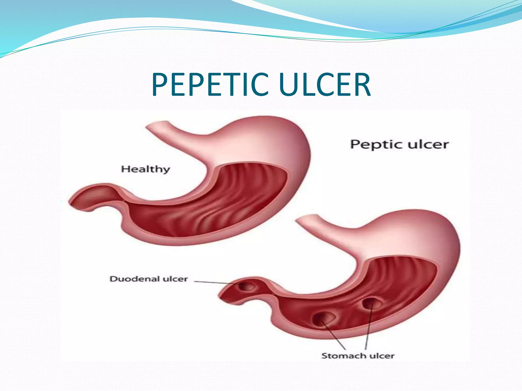 PEPTIC ULCER.pptx | Digestive Disorders | Diseases and Conditions