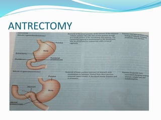PEPTIC ULCER.pptx | Digestive Disorders | Diseases and Conditions