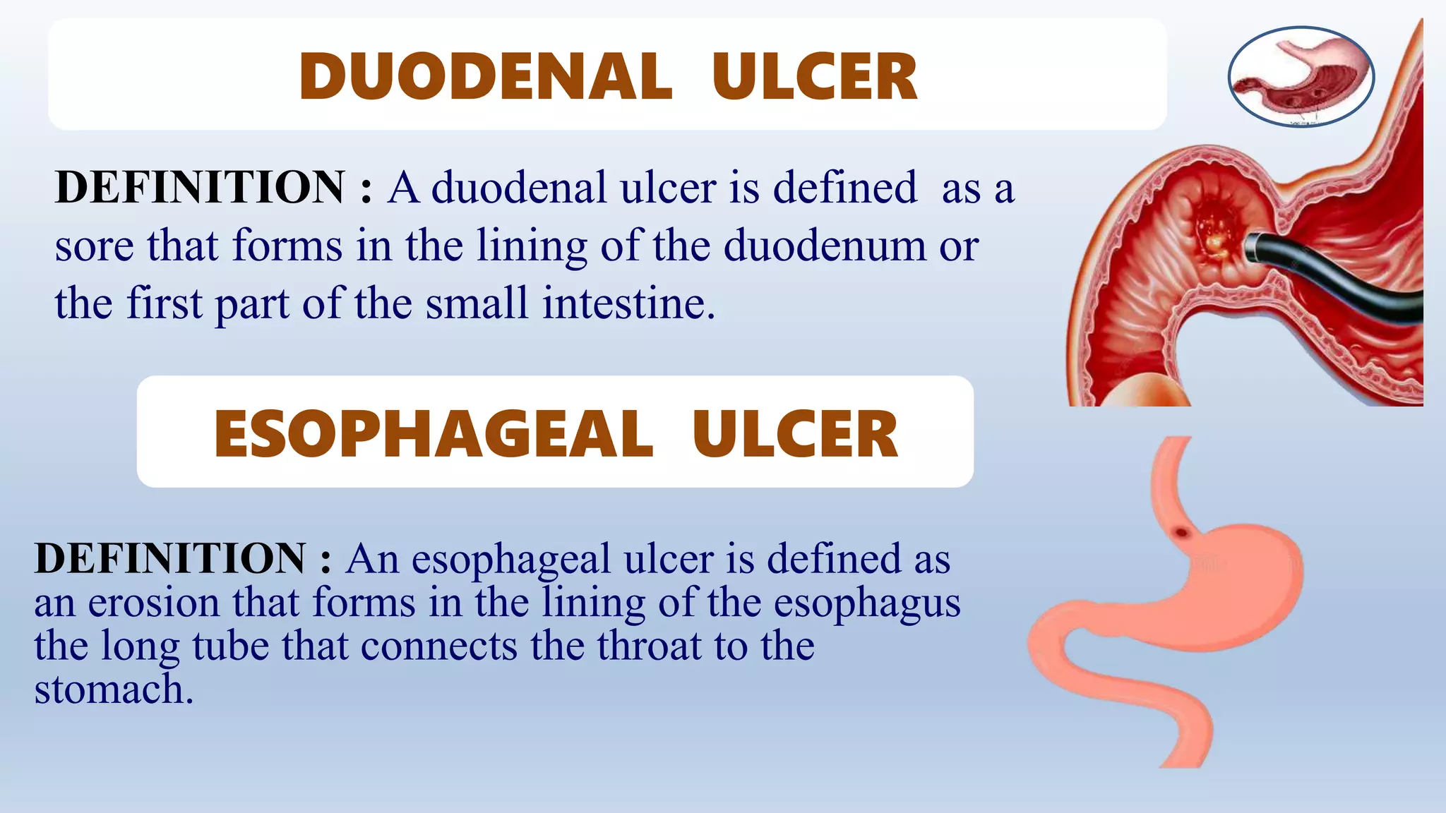 PEPTIC ULCER.pptx