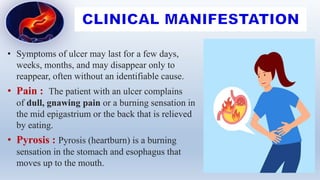 PEPTIC ULCER.pptx