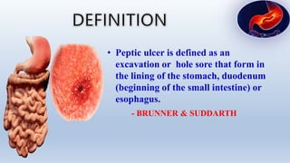 PEPTIC ULCER.pptx