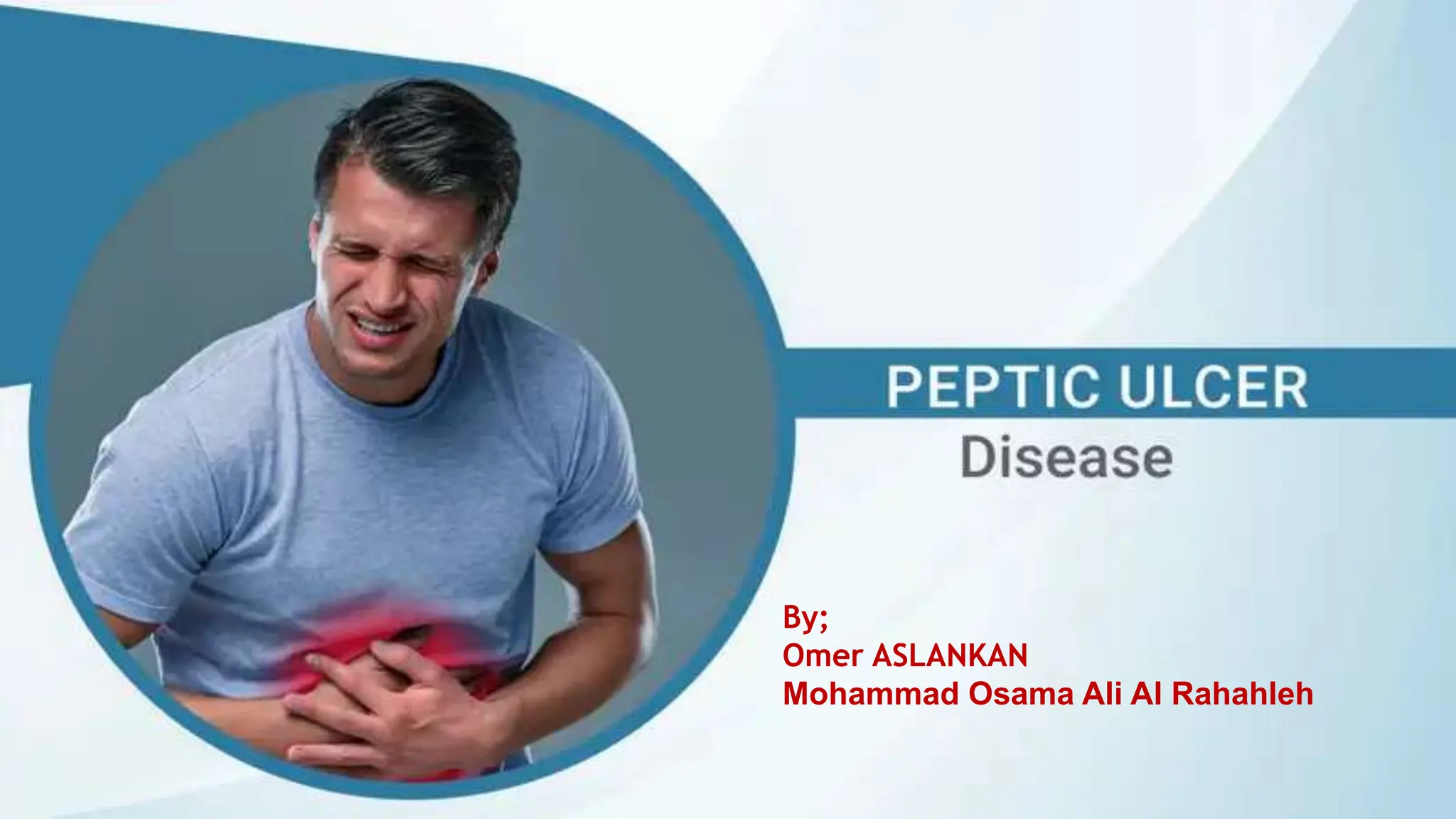 peptic ulcer(gastric, duodenal stress ulcers ppts | PPTX
