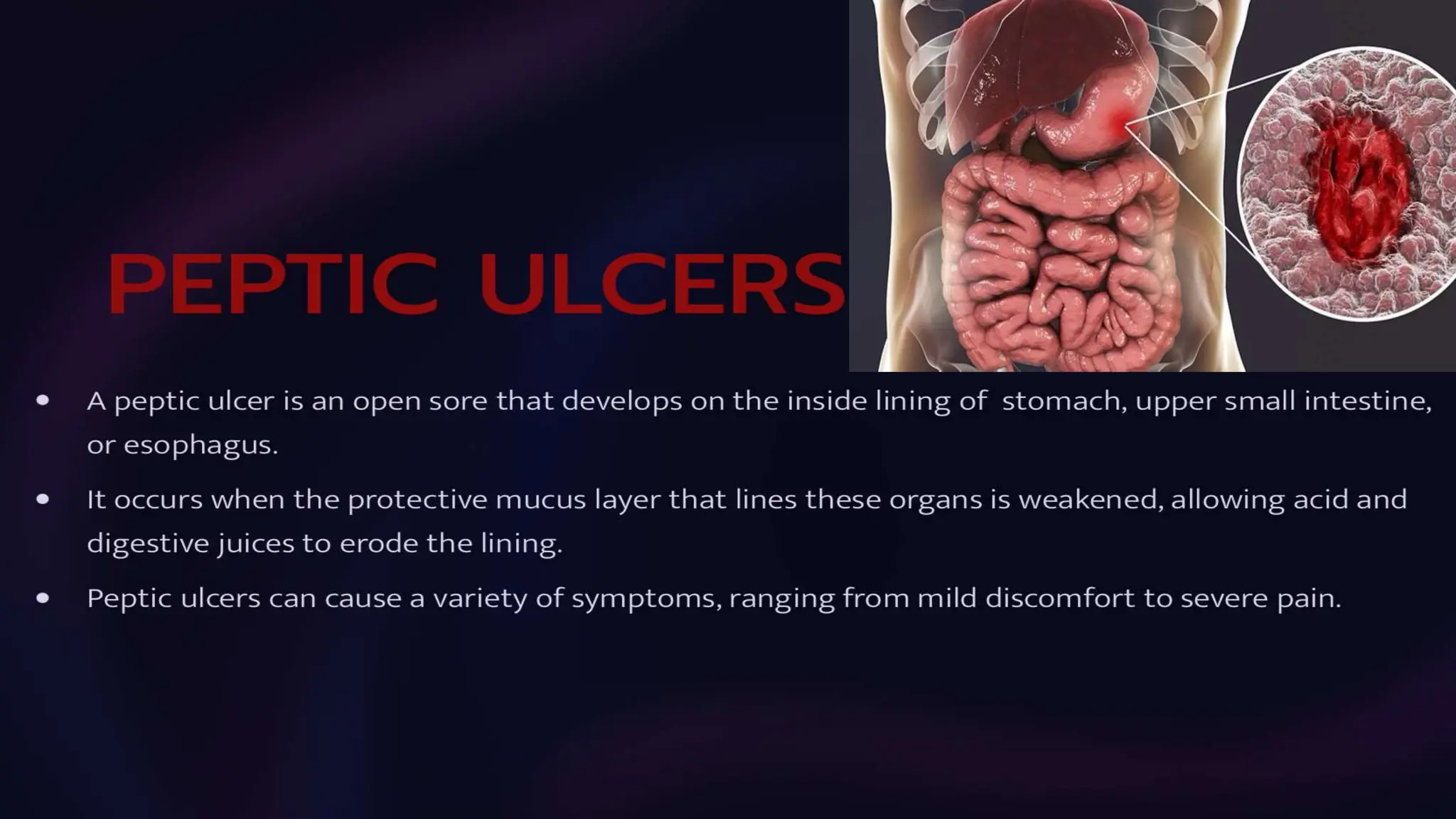 peptic ulcer(gastric, duodenal stress ulcers ppts | PPTX