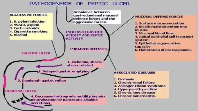 peptic ulcer(gastric, duodenal stress ulcers ppts | PPTX