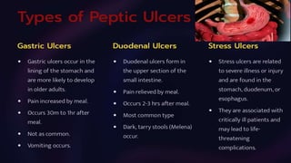 peptic ulcer(gastric, duodenal stress ulcers ppts | PPTX