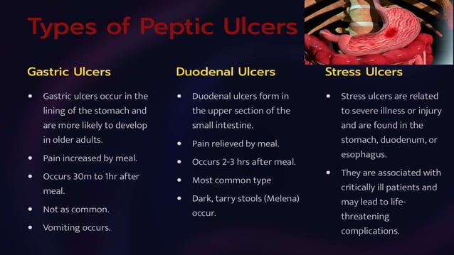 peptic ulcer(gastric, duodenal stress ulcers ppts | PPTX