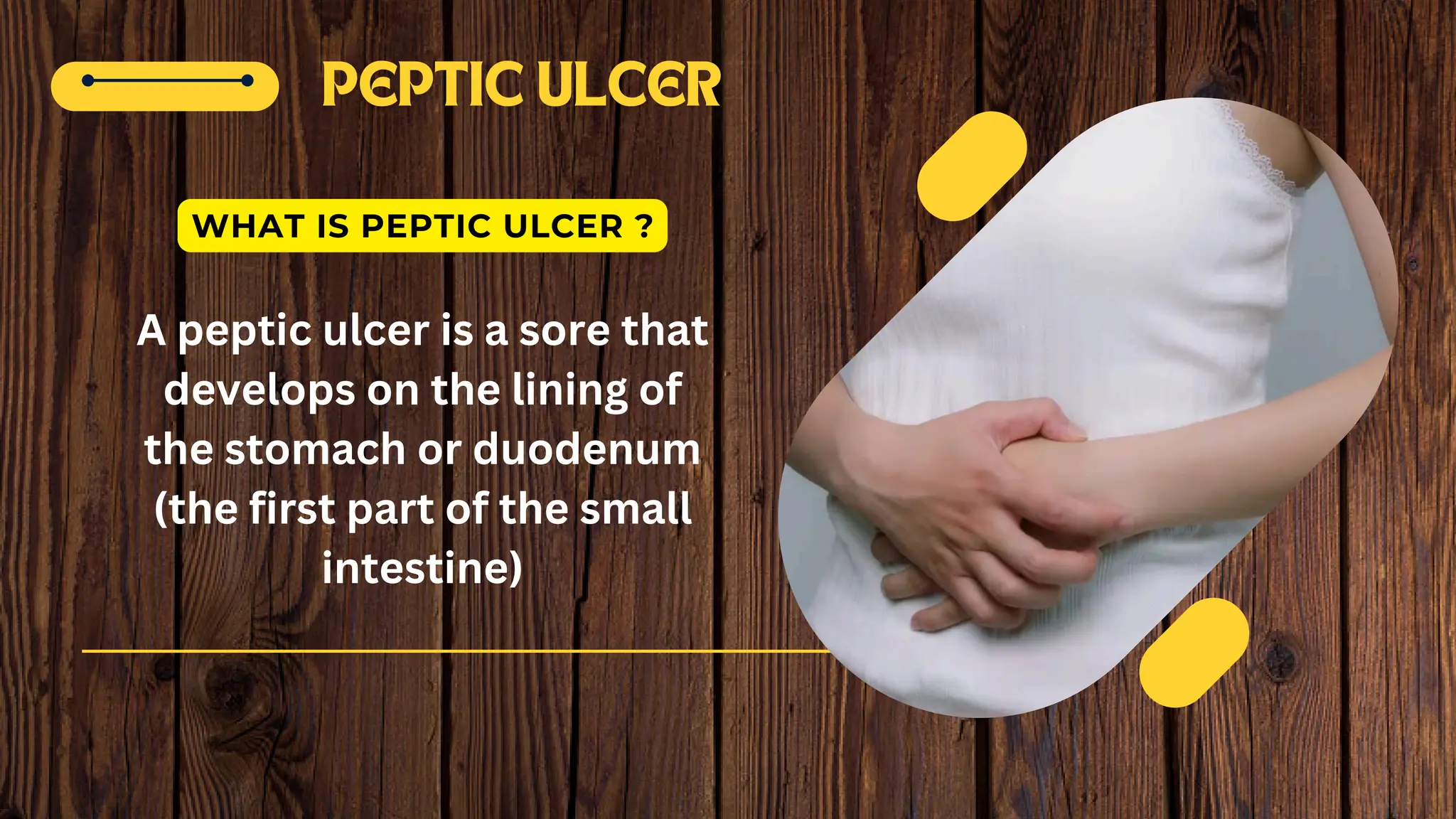 Peptic Ulcer treatment symptoms and privention | PPT