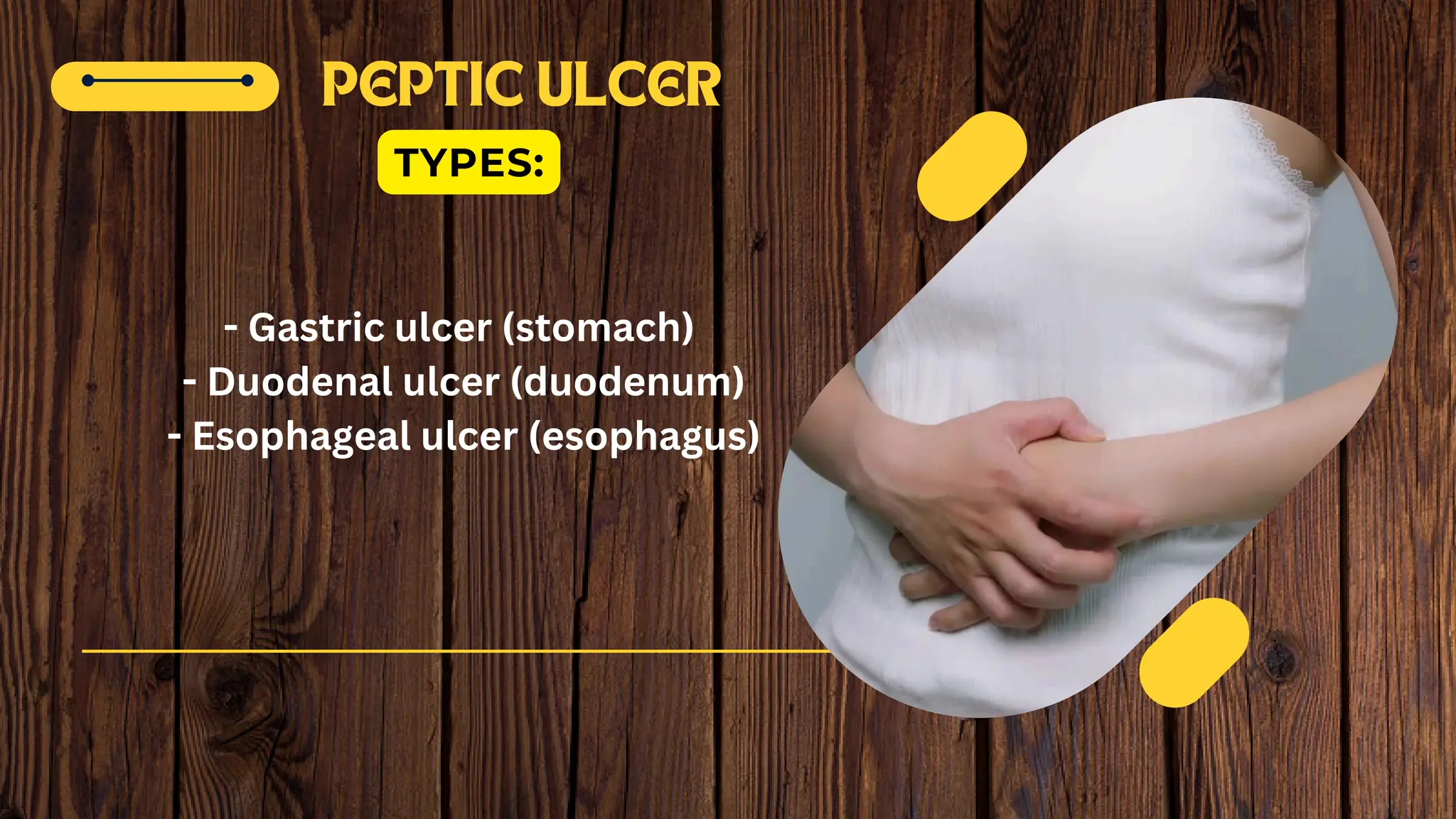 Peptic Ulcer treatment symptoms and privention | PDF | Digestive ...