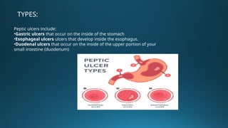 Case presentation on PEPTIC ULCER disease with soap note.pptx