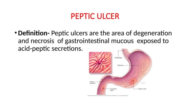 PEPTIC ULCER Treatment according Ayurved | PPTX